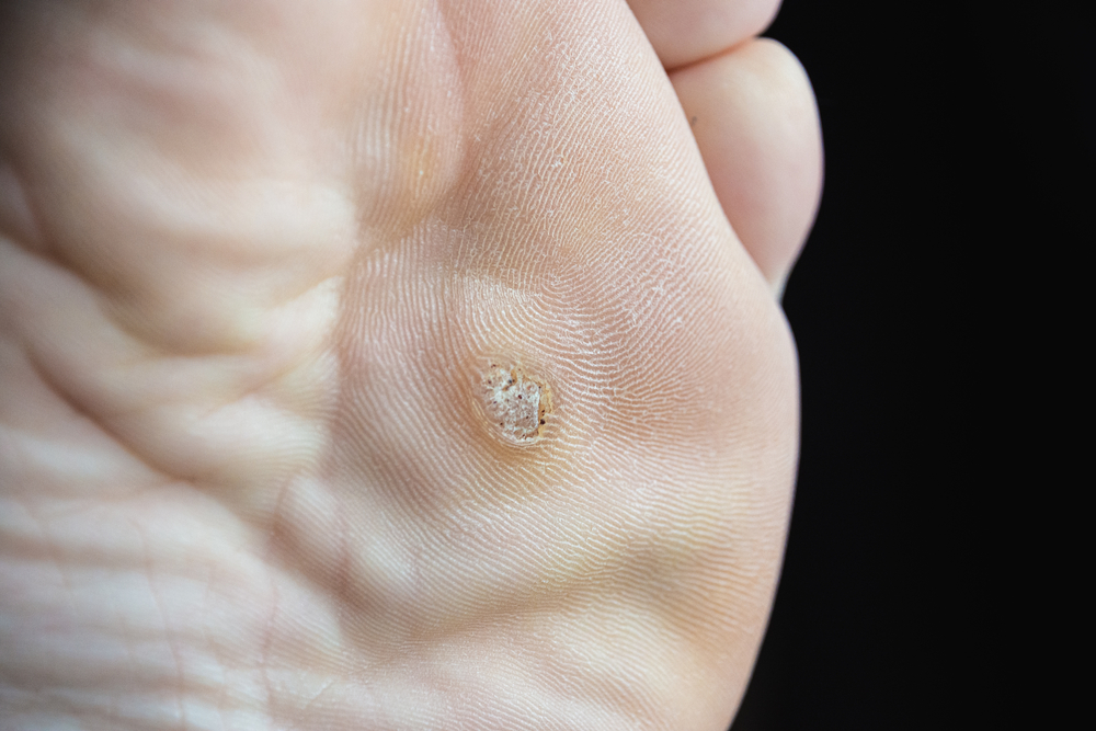 Active Footcare What Does A Verruca Look Like